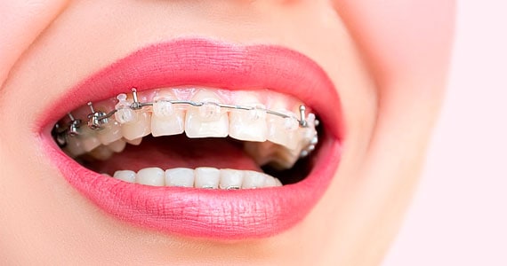 Ortodoncia | Esthetic Dental Center