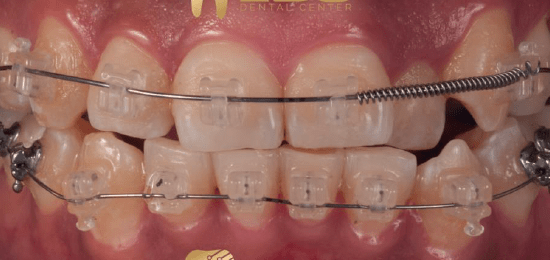 Ortodoncistas Estéticos en Qro. | Esthetic Dental Center